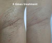China 4 Wavelengths Diode Laser Hair Removal Machine 808nm/755 808nm 1064nm With User Manual for sale
