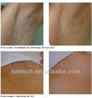 China Professional Clinic Laser Hair Removal Machine Diode 3 waves KM960D for sale