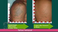 China Commercial Q Switched Laser Tattoo Removal Machine 1064nm 532nm 755nm for sale