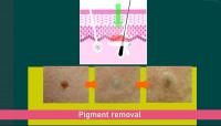 China 755nm Picosecond Laser Machine For Hair Removal / Tattoo Removal English Languages Option for sale