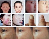 China 50W 980 Nm Diode Laser Spider Vein Removal Machine For Blood Vessel Treatment Solution for sale