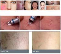 China Skin Rejuvenation 980nm Diode Laser Machine Portable Laser Spider Vein Removal Machine for sale