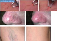China Skin Rejuvenation 980nm Diode Laser Machine Portable Laser Spider Vein Removal Machine for sale