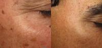 China Home Nd YAG Medical Laser Beauty Machine For Weight Loss / Skin Tightening for sale