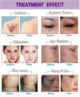 China Long Pulse Nd YAG Laser Hair Removal Machine Portable For Commercial for sale