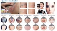 China 532nm 1064nm 1320nm Q Switch ND Yag Laser Machine For Skin Whitening / Dark Circles for sale