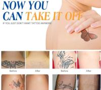 China Custom Q Switch ND Yag Laser Machine For Tattoo Removal / Acne Treatment for sale