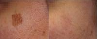 China 6mm YAG Bar Q Switch Laser Machine Tattoo Removal 1064nm 532nm 1320nm for sale