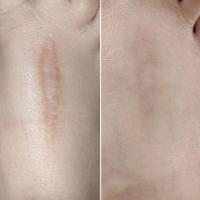 China 40w 60W Fractional CO2 Laser Machine For Wrinkle Removal Stretch Mark Scar Removal Tightening for sale
