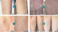 China 755nm 808nm 1064nm Multifunctional Beauty Machine Pico Nd YAG Laser With RF Technology for sale