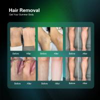 China 755nm Alex Laser 1064nm Long Pulse Nd Yag Hair Removal Alexandrite Laser Candle Machine Manufacturer Price for sale