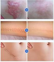 China Silicone patches anti scars high quality silicone scar treatment sheets patch for sale