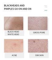 China Soften Lackhead Derived Essence Face Serum Blackhead Remover Serum for sale