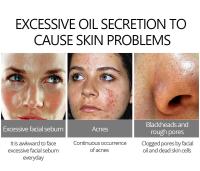 China Gentle Skin Care Acne Treatment Cream 30g For Acne Prone Sensitive Skin for sale