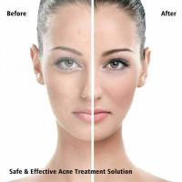 China Vegan Friendly Hydrocolloid Acne Pimple Patch For Covering Zits for sale