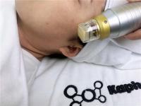 China Portable Fractional RF Microneedling Machine 81 Pin 1MHz for Face Lifting Stretch Marks Scar Removal for sale