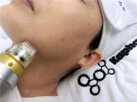 China 25 Pin 3.0mm Fractional RF Microneedle Machine for Scar Removal and Skin Tightening for sale