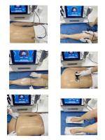 China Tecar EMS Shockwave Therapy Machine 300W for ED Body Slimming Cellulite Removal for sale