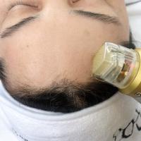 China Fractional RF Microneedling Machine for Acne Scars Skin Resurfacing 180W for sale