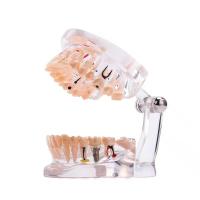China 32 Tooth Full Month Implant Disease Teeth Model Clear Design  Dental Pathology Model for sale