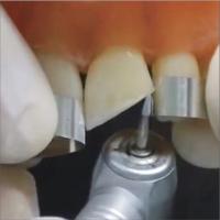 China Dental Sectional Matrix System Steel Matric Bands  for Restorative Dentistry for sale