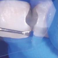 China Anterior Matrix Strips Dental Roll Dental Resin Strip Roll for sale