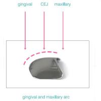 China Sectional Matrix Band Dental Use In Teeth M2 for sale