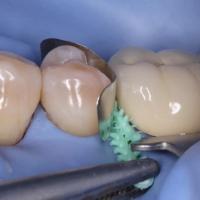 China Composite Dental Sectional Matrix System Plastic Adaptive Wedges W3 1.0 for sale