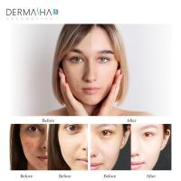 China Water Jet Aqua Peel Dermabrasion Oxigen Hydrafacial Machine Microdermabrasion for sale