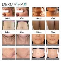 China High Intensiy Foused Ultrasound 7d Lipo Hifu Machine Factory Price Anti Wrinkle Skin Tightening Beauty Equipment for sale