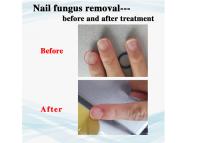 China 30W Input Power Spider Vein Removal 980 nm diode laser	Machine Nails Fungus Removal 1 - 20Hz Frequency for sale