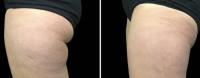 China 4 In 1 Lipolaser 600w 90kPa Cool Slimming Machine for sale