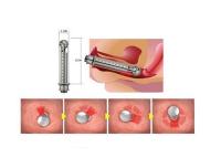 China Acne Stretch Marks Co2 Fractional Laser Machine ODM OEM for sale