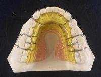 China High Accuracy Orthodontic Removable Appliance Safety Clear Hawley Retainer for sale
