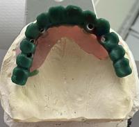 China High Precision Implant Supported Crown Stable And Easy Maintenance for sale