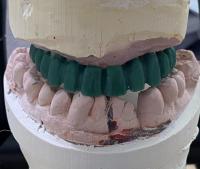 China High Precision Implant Supported Crown Stable And Easy Maintenance for sale