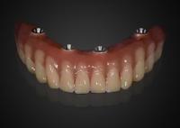 China Customized Replacing Dental Implant Crown Wear Resistant For Long Term Use for sale