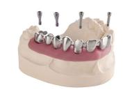China Customized Replacing Dental Implant Crown Wear Resistant For Long Term Use for sale