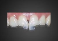 China IPS 0.2mm Ultra Thin Emax Veneers Stain Resistant With High Strength for sale