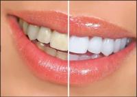 China IPS 0.2mm Ultra Thin Emax Veneers Stain Resistant With High Strength for sale