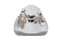 China High Purity Titanium Partial Dentures Surface Polishing And Anti Bacterial Spot for sale