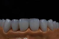 China Highly Translucent Esthetic Zirconia Crowns Precise Fit with Natural Looking for sale