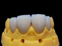 China High Esthetics Dental Lab Crowns Porcelain Layered Zirconia Staining Resistance for sale