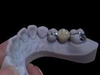 China Accurate White Long Lasting Maryland Bridge Dental Customizable For Restoration for sale
