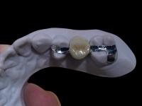 China Accurate White Long Lasting Maryland Bridge Dental Customizable For Restoration for sale