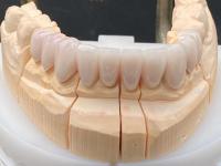 China High Esthetics Dental Lab Crowns Porcelain Layered Zirconia Staining Resistance for sale