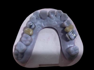 China Highly Precise PFM Crown Dental Alloy Ni Free Metal Porcelain Crowns for sale