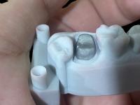 China Corrosion Resistant Metal Post And Core High Adhesion For Dental Restoration for sale