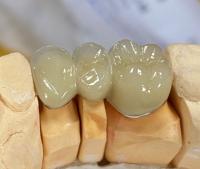China Precise Esthetic Strong Dental PFM Porcelain Fused To Metal Crown In Dentistry for sale