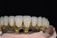 China Natural Looking Crown Porcelain Fused To Metal High Precision For Dental Implants for sale